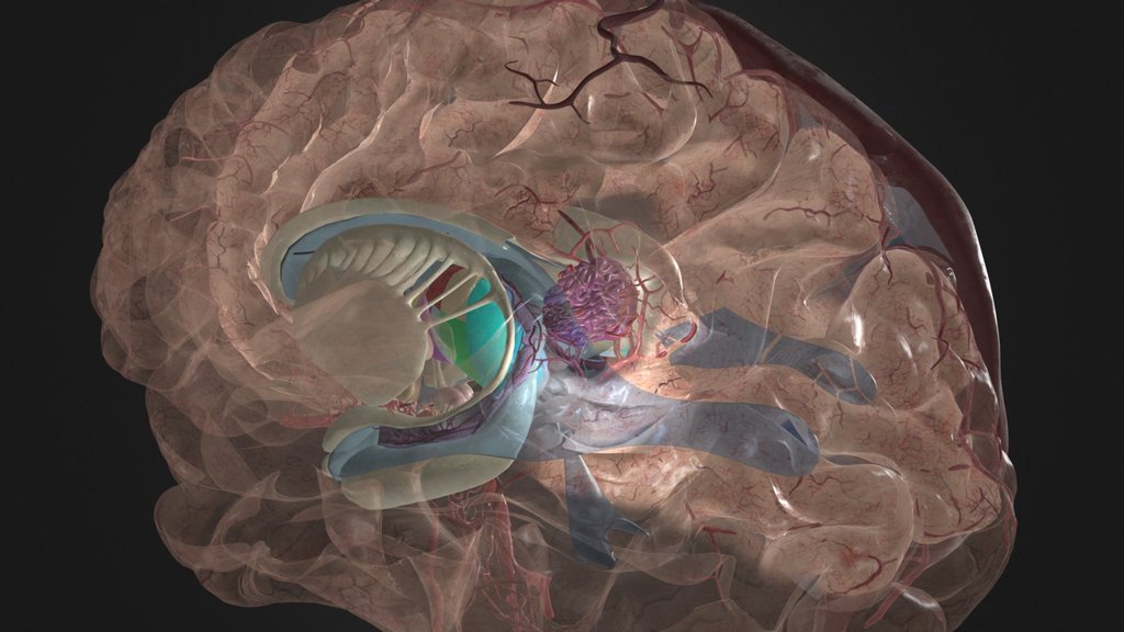 Callosal Arteriovenous Malformation | 3D Models | The Neurosurgical Atlas