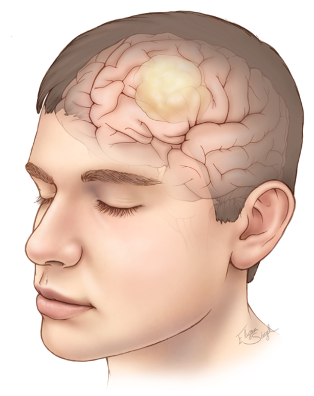 What Are The Causes Of Glioma Aaron Cohen Gadol MD What Are The Causes Of Glioma Aaron Cohen Gadol MD