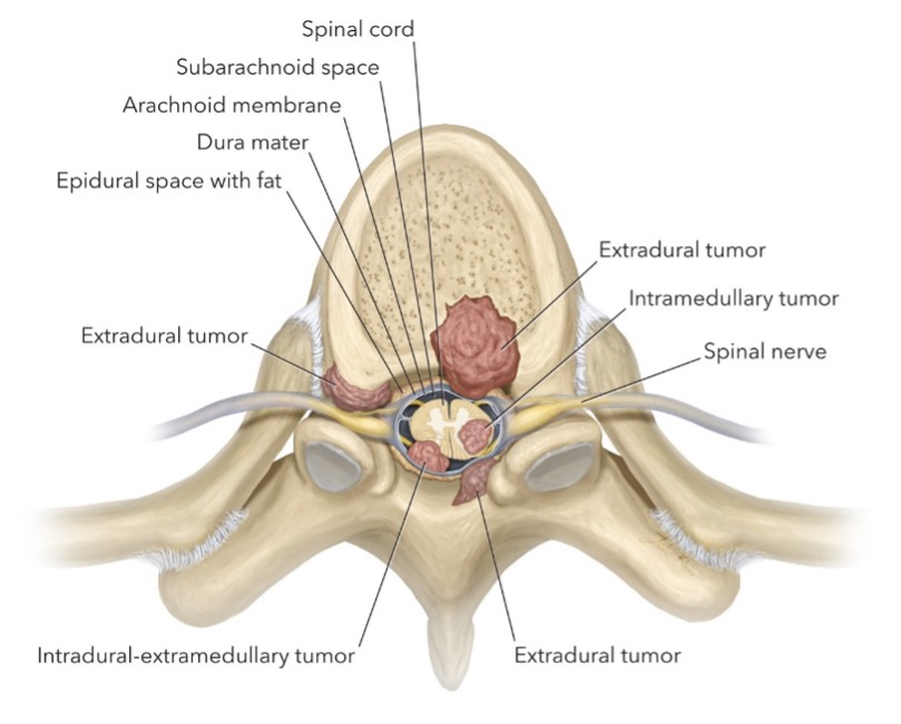 Tumor Of Brain And Spinal Cord Infoupdate