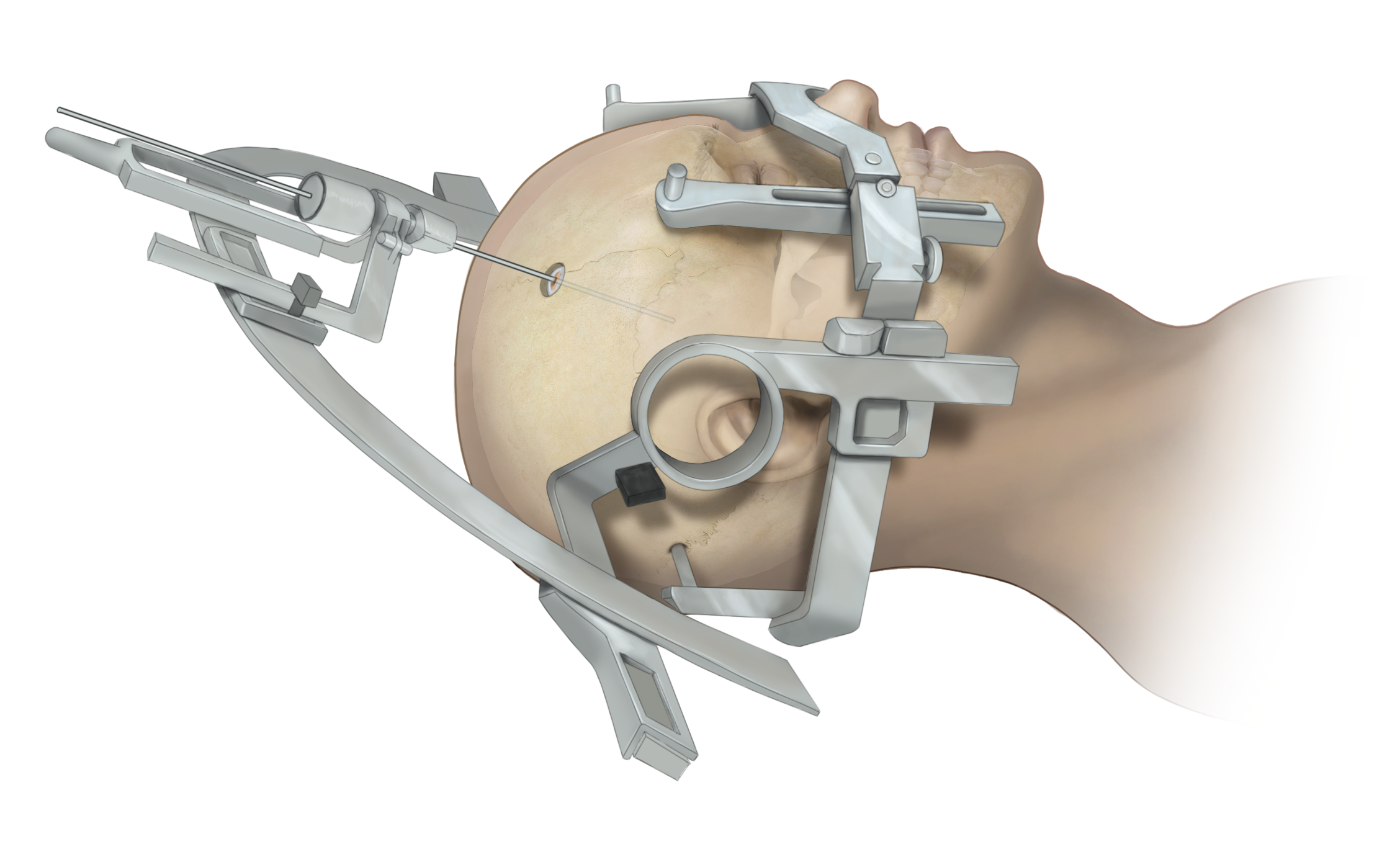 Stereotactic Biopsy Stereotactic Biopsy