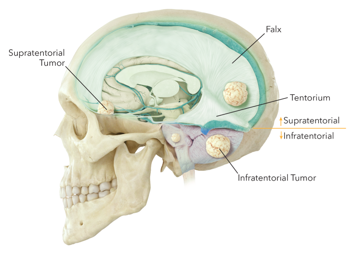 Tumor Cerebral Maligno