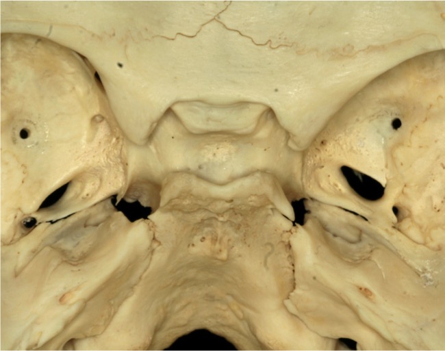 Transcranial Classification of the Clival Region | Neuroanatomy | The ...