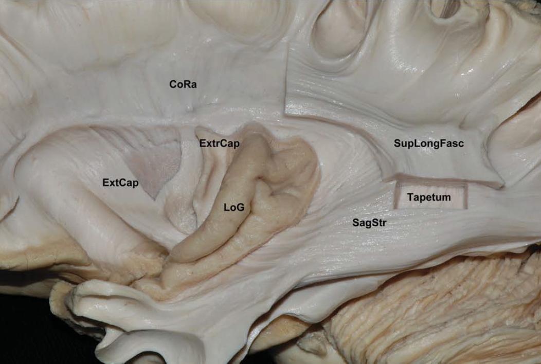 Lateral View of the Left Hemisphere With the Vertical Segment of the ...