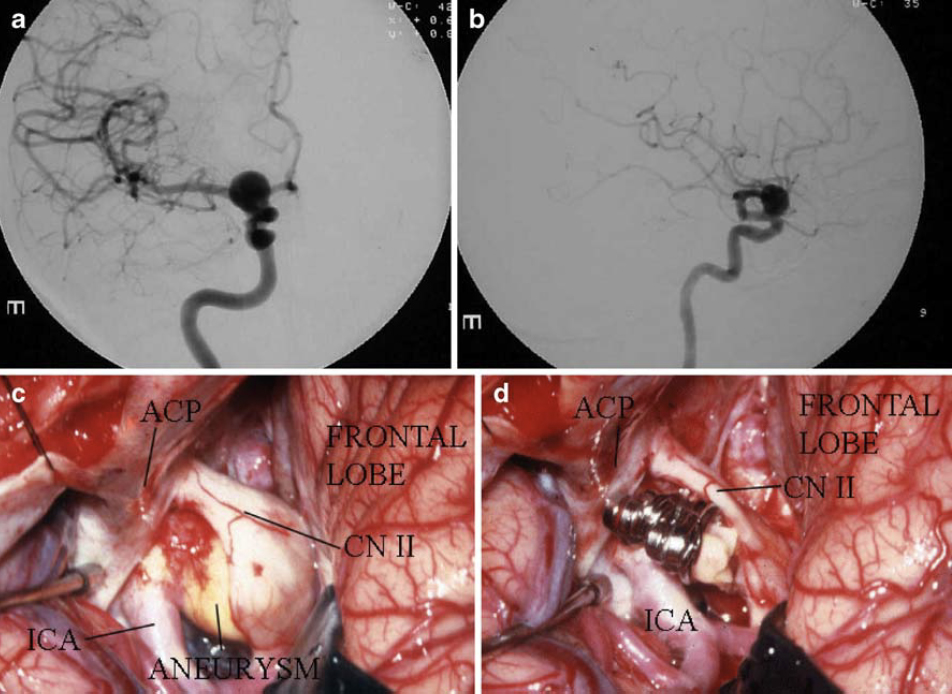 Angiogram of Clinoidal Aneurysm and Surgical Correlate | Neuroanatomy ...