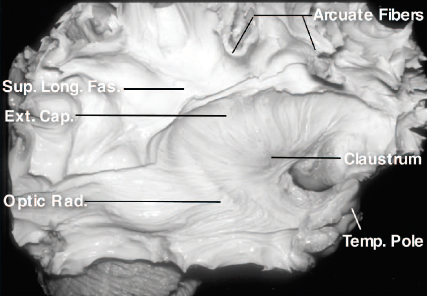 Lateral View of Stepwise Dissection of the Right Hemisphere ...