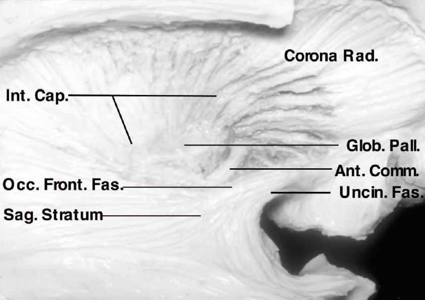 Lateral View of Stepwise Dissection of the Right Hemisphere ...