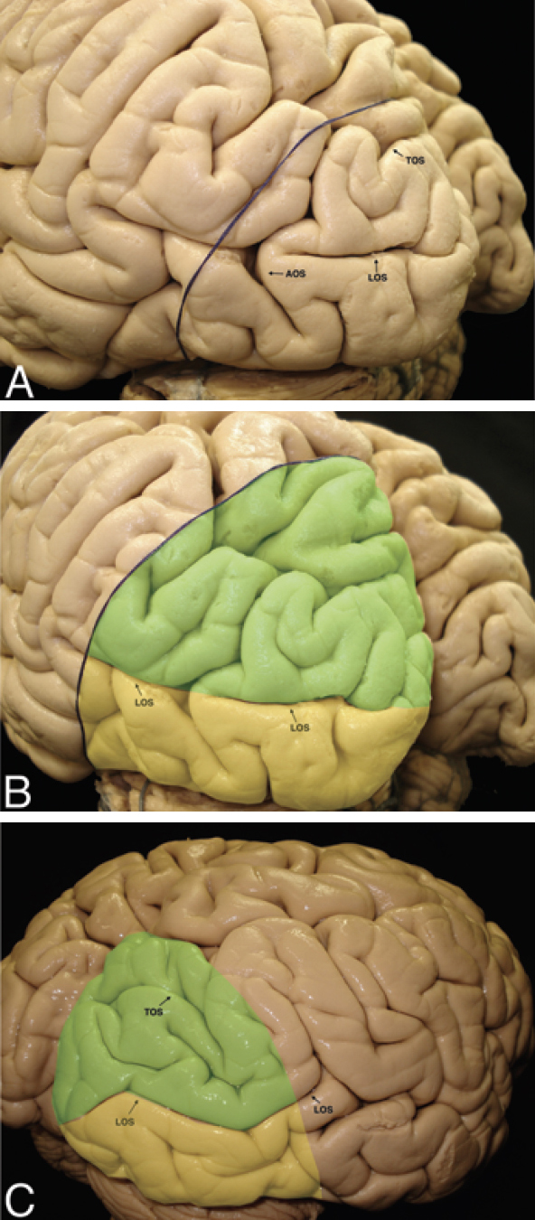 Lateral View of the Left Hemisphere | Neuroanatomy | The Neurosurgical ...