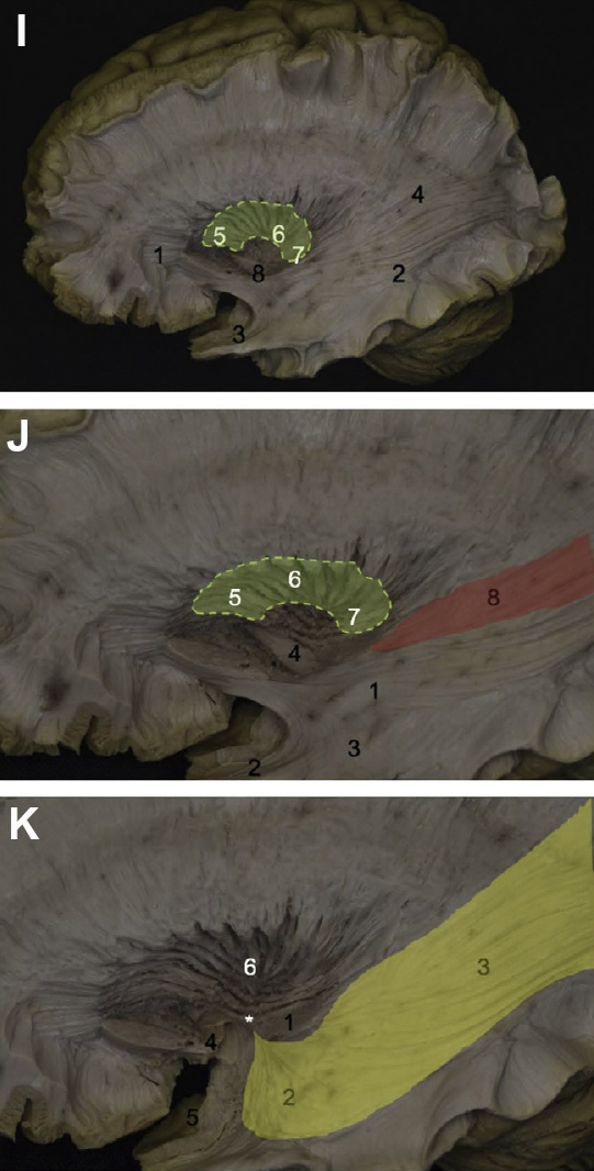 Left Cerebral Hemisphere After Removing the Cortical Gray Matter and ...