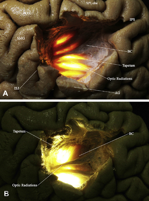 Lateral View of the Brain With a Window Centered at the Level of the ...