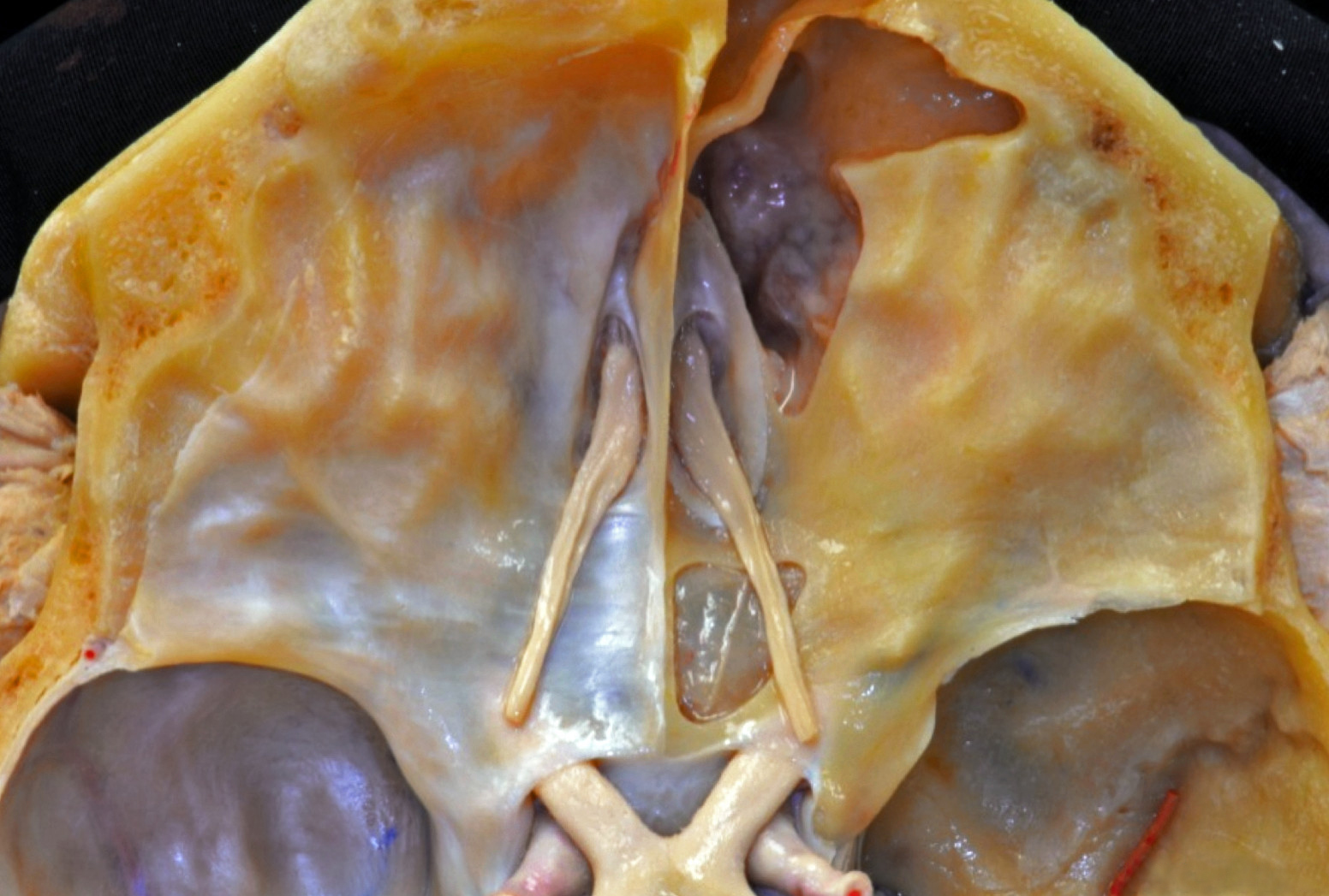 Cranial Part II (31-60) | The Neurosurgical Atlas