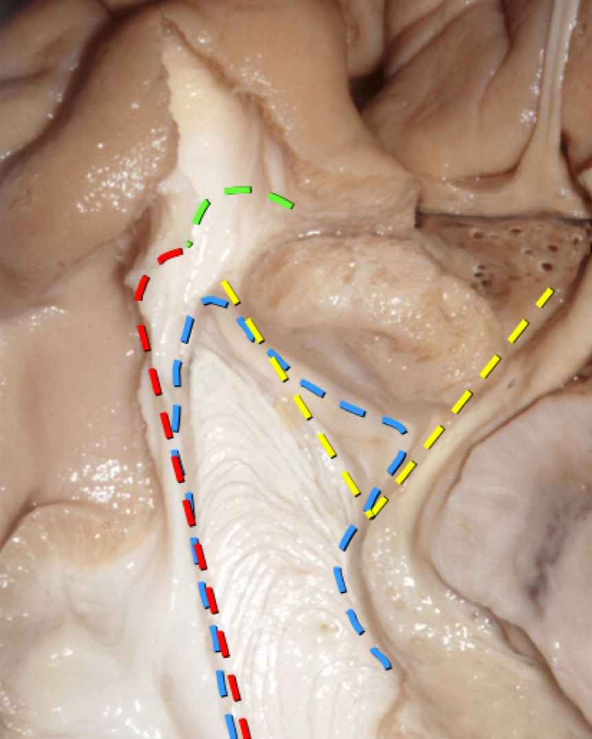 Inferior View of the Right Medial Temporal Lobe and Subcallosal Region ...