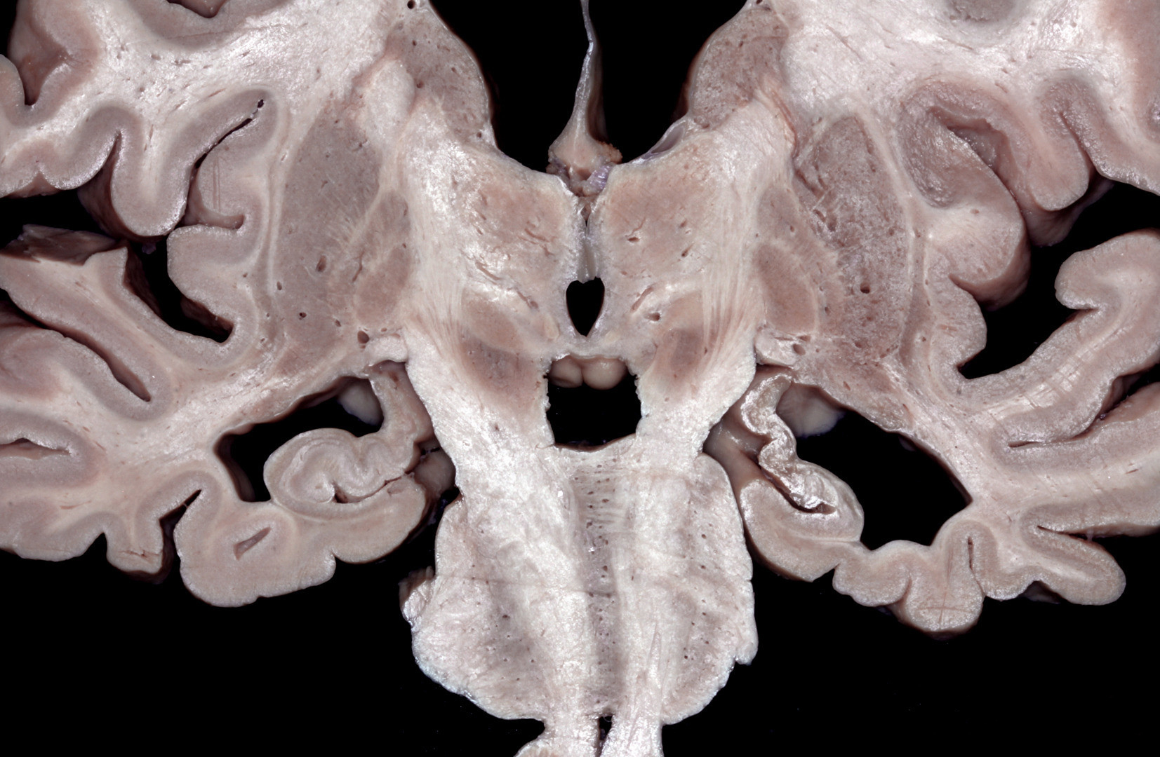Cranial Part II (31-60) | The Neurosurgical Atlas