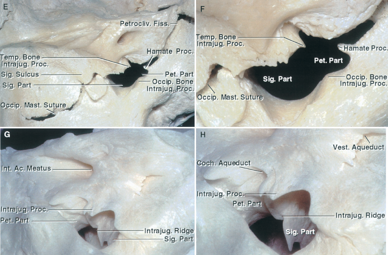 Jugular Foramen | The Neurosurgical Atlas