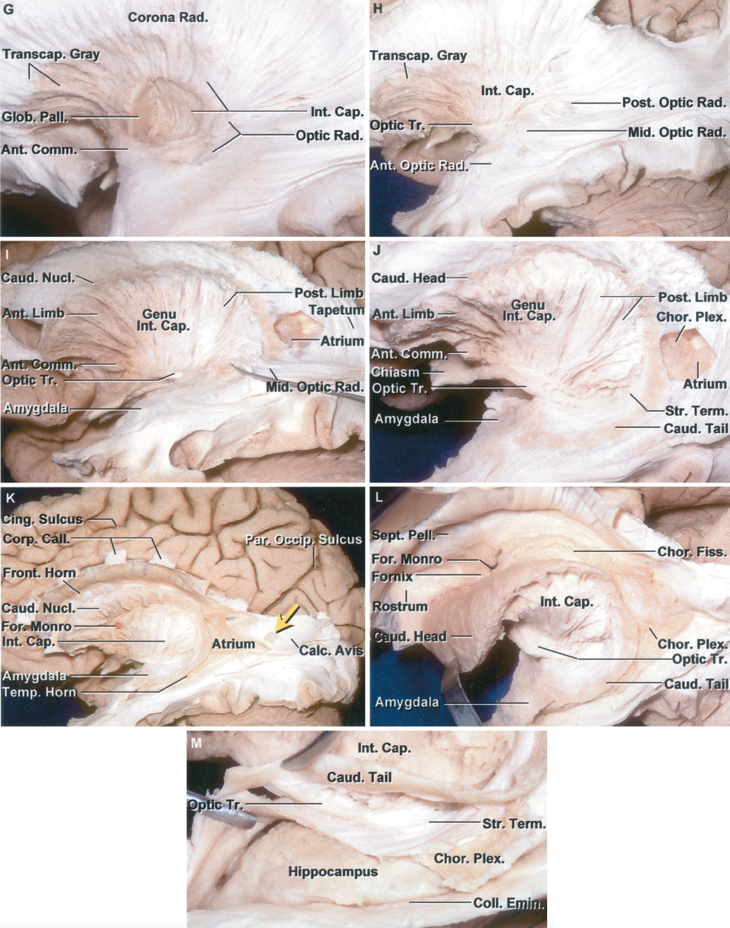 Stepwise Fiber Dissection of the Left Cerebral Hemisphere G-M ...