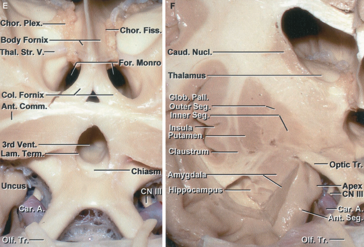 Stepwise Dissection of the Cerebral Hemispheres, Beginning Anteriorly E ...