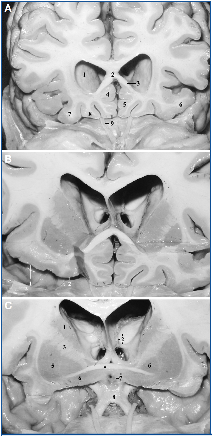 Coronal Perspective of Deep Nuclei | Neuroanatomy | The Neurosurgical Atlas