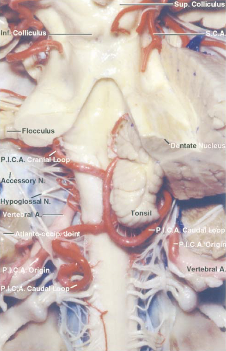 Relationships Between the PICAs and the Lower Pole of the Tonsils ...