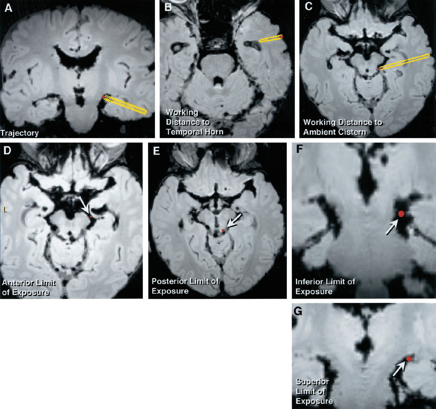 Perimesencephalic Cisterns | The Neurosurgical Atlas