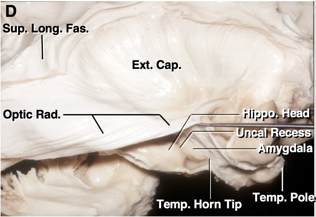 Hippocampal Head and Temporal Pole Anatomy | Neuroanatomy | The ...