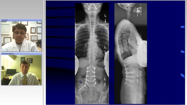 Grand Rounds-Minimally Invasive Lumbar Deformity Surgery | Grand Rounds ...