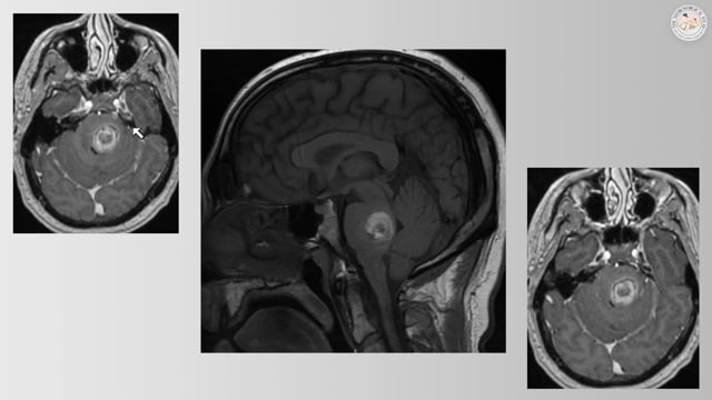 Large Pontine Cavernous Malformations: Telovelar Route | Operative ...