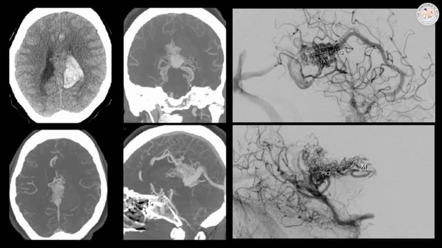 Posterior Callosal (Splenial) AVM | Operative Video Cases | The ...