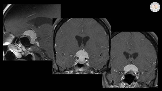Recurrent Tuberculum Sella Meningioma after Endoscopic Transnasal ...