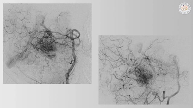 Vermian AVM: Intraop Rupture-“Commando” Operation | Operative Video ...