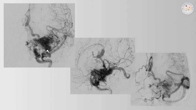 Large Medial Temporal/Choroidal AVM | Operative Video Cases | The ...