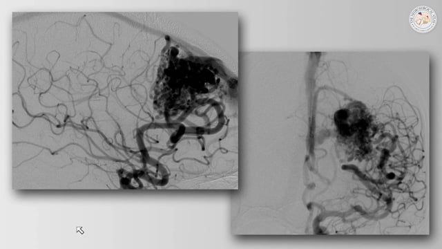 Frontal AVM: Staying out of Trouble | Operative Video Cases | The ...