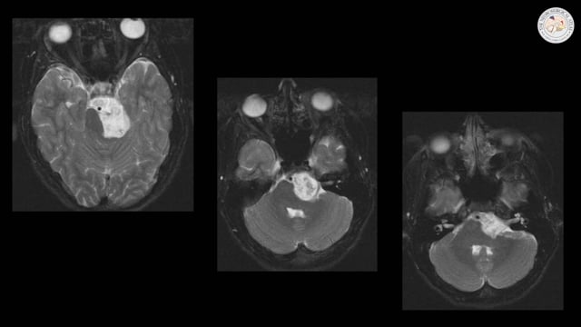 Recurrent Epidermoid: Anterior Petrosal Approach | Operative Video ...