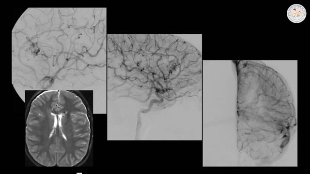 Recurrent Pediatric Callosal AVM | Operative Video Cases | The ...