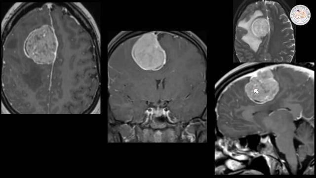 Parasagittal/Parafalcine meningioma: Resection Principles | Operative ...