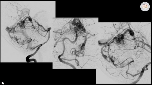 Complex Vermian AVM | Operative Video Cases | The Neurosurgical Atlas