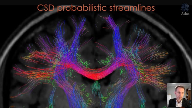 Tractography Technology in Neurosurgery | Grand Rounds/Virtual OR ...