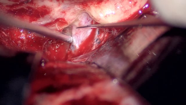 Middle Fossa Approach for Resection of Vestibular Schwannoma | The ...