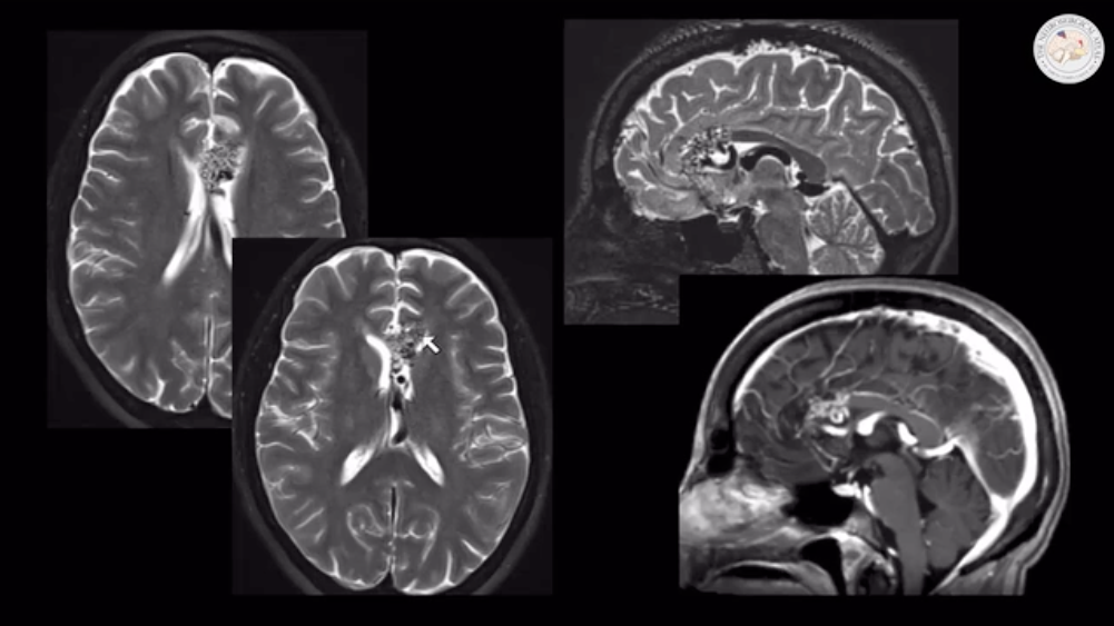 Anterior Callosal AVM: Managing Intraoperative Bleeding | Operative ...