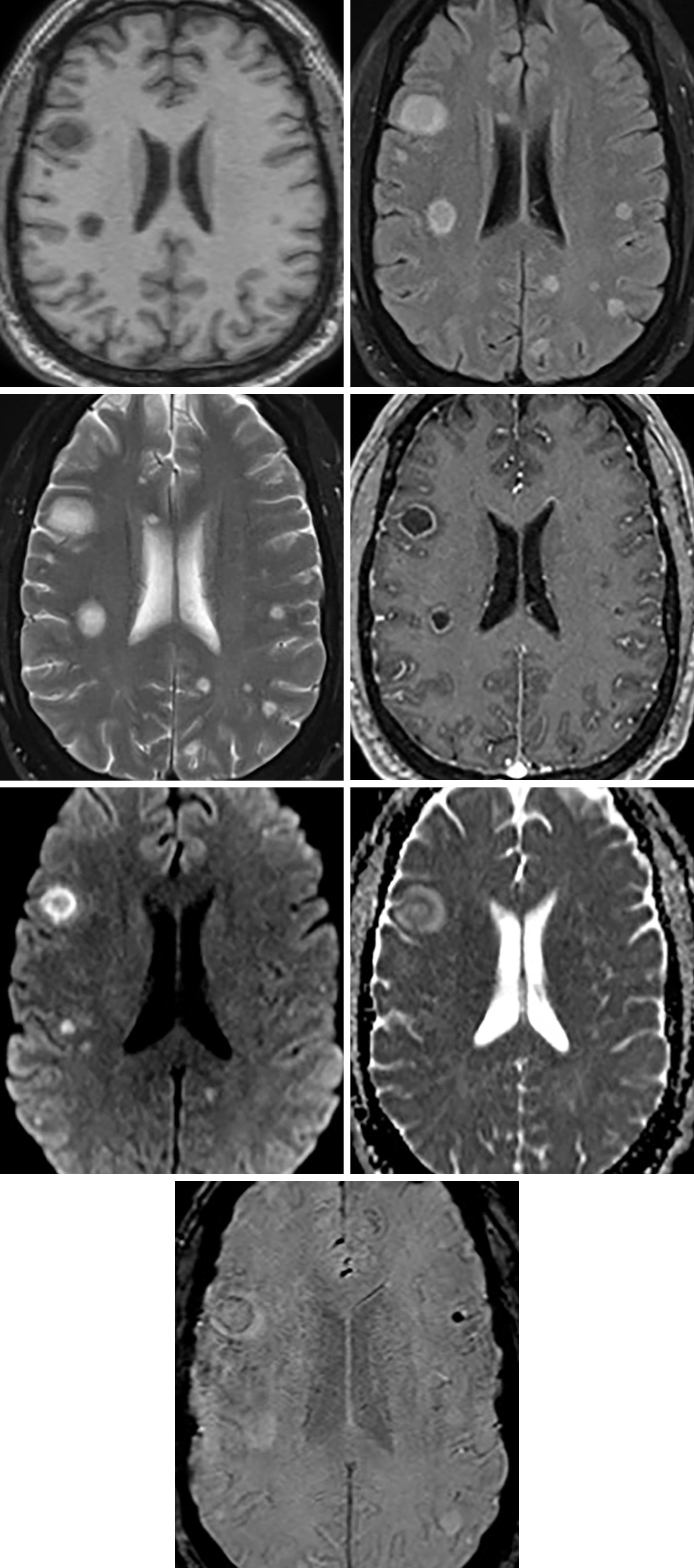 Histoplasmosis | The Neurosurgical Atlas