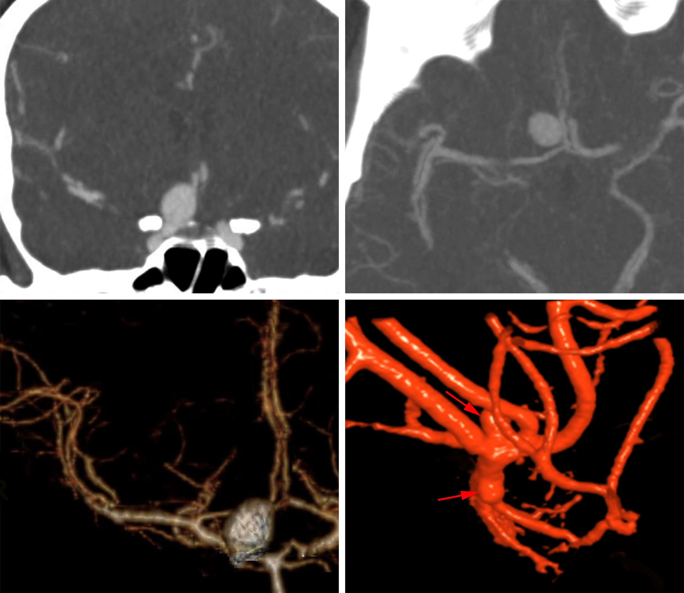 Diagnosis and Evaluation of Aneurysmal Subarachnoid Hemorrhage | The ...