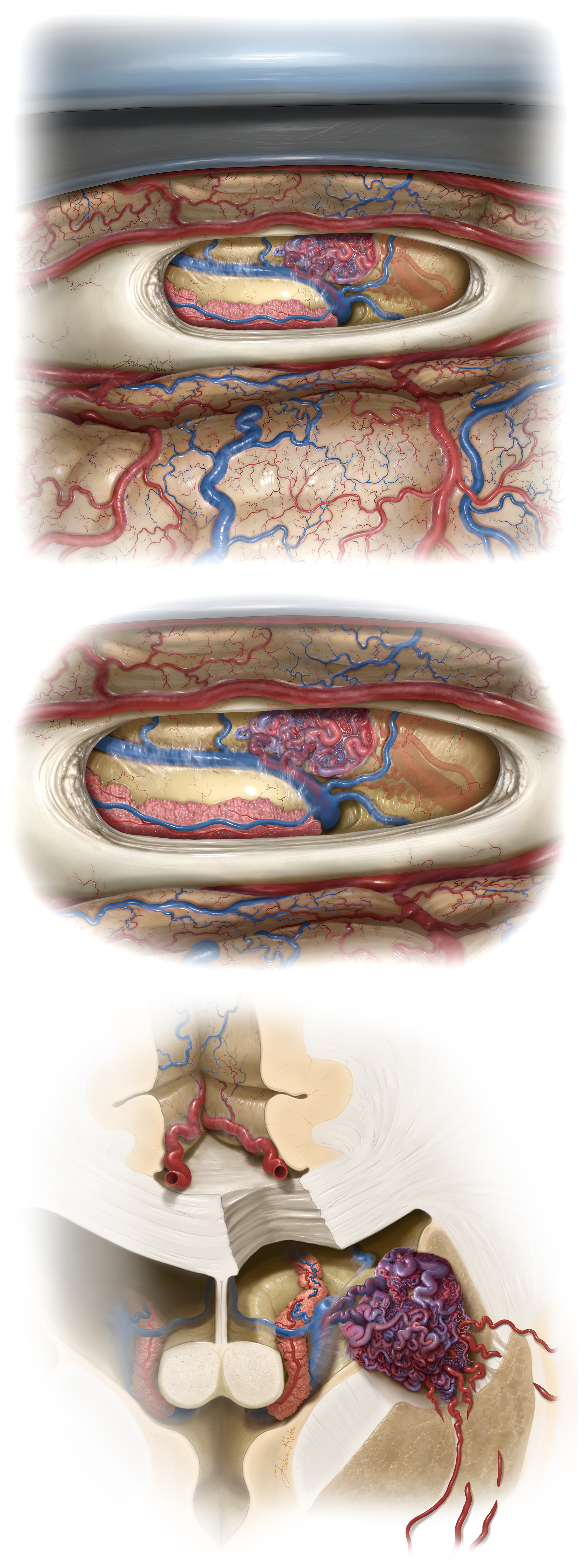 Deep Subcortical AVMs | The Neurosurgical Atlas