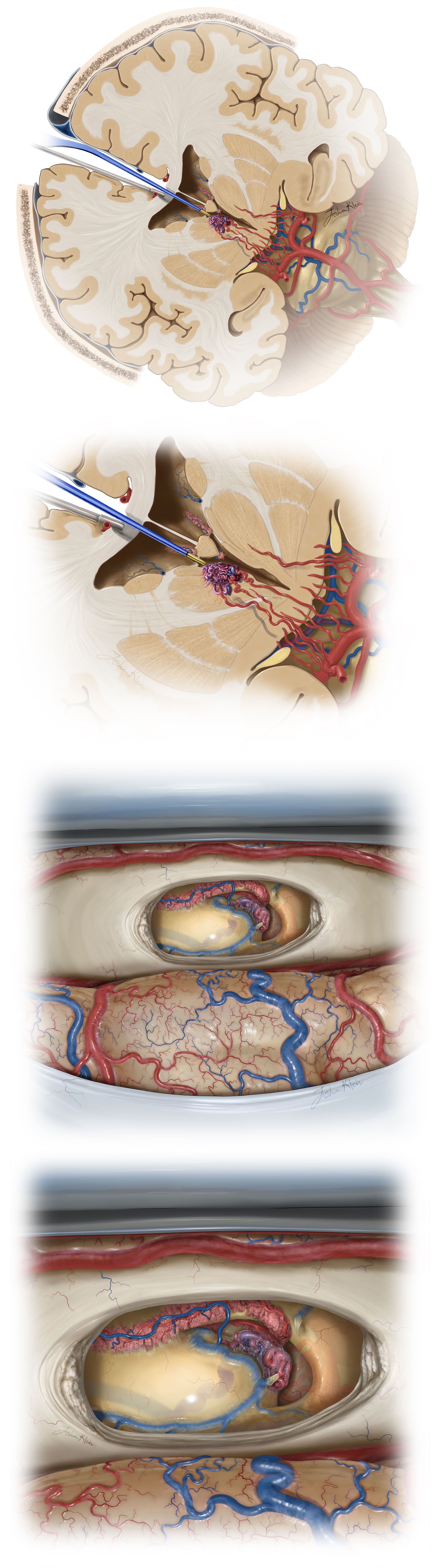 Deep Subcortical AVMs | The Neurosurgical Atlas