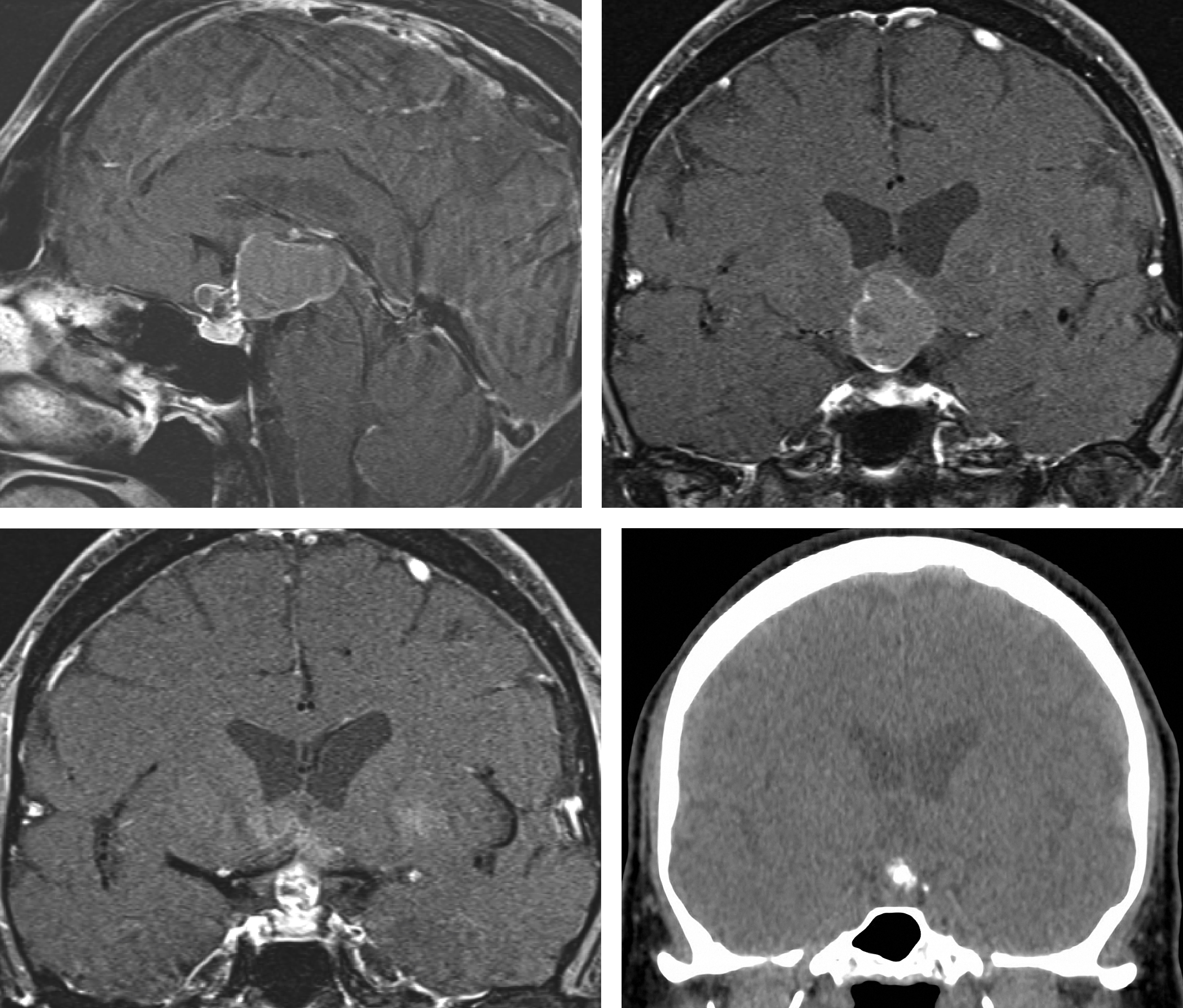 Ventricular Tumors | The Neurosurgical Atlas