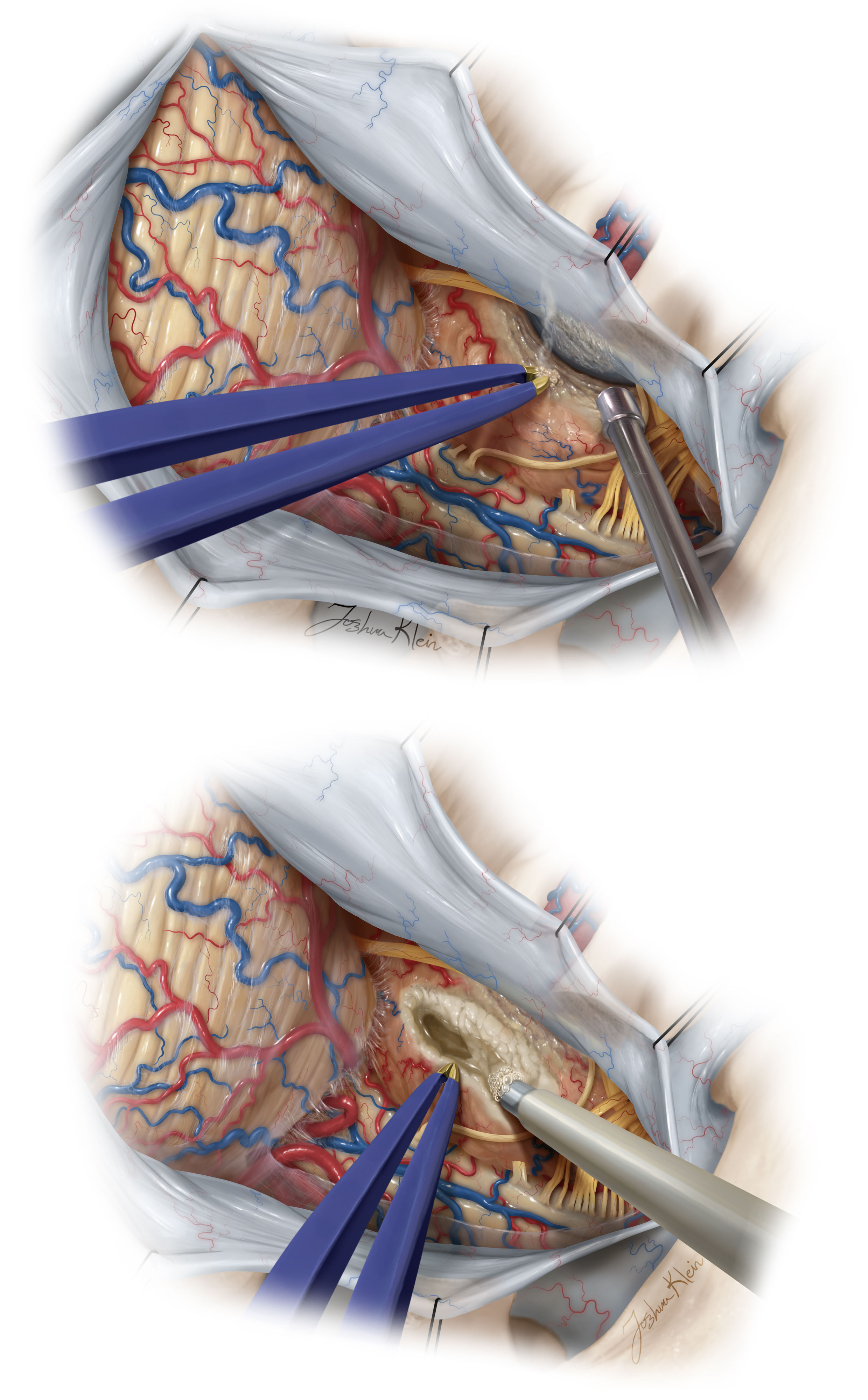 Foramen Magnum Meningioma | The Neurosurgical Atlas
