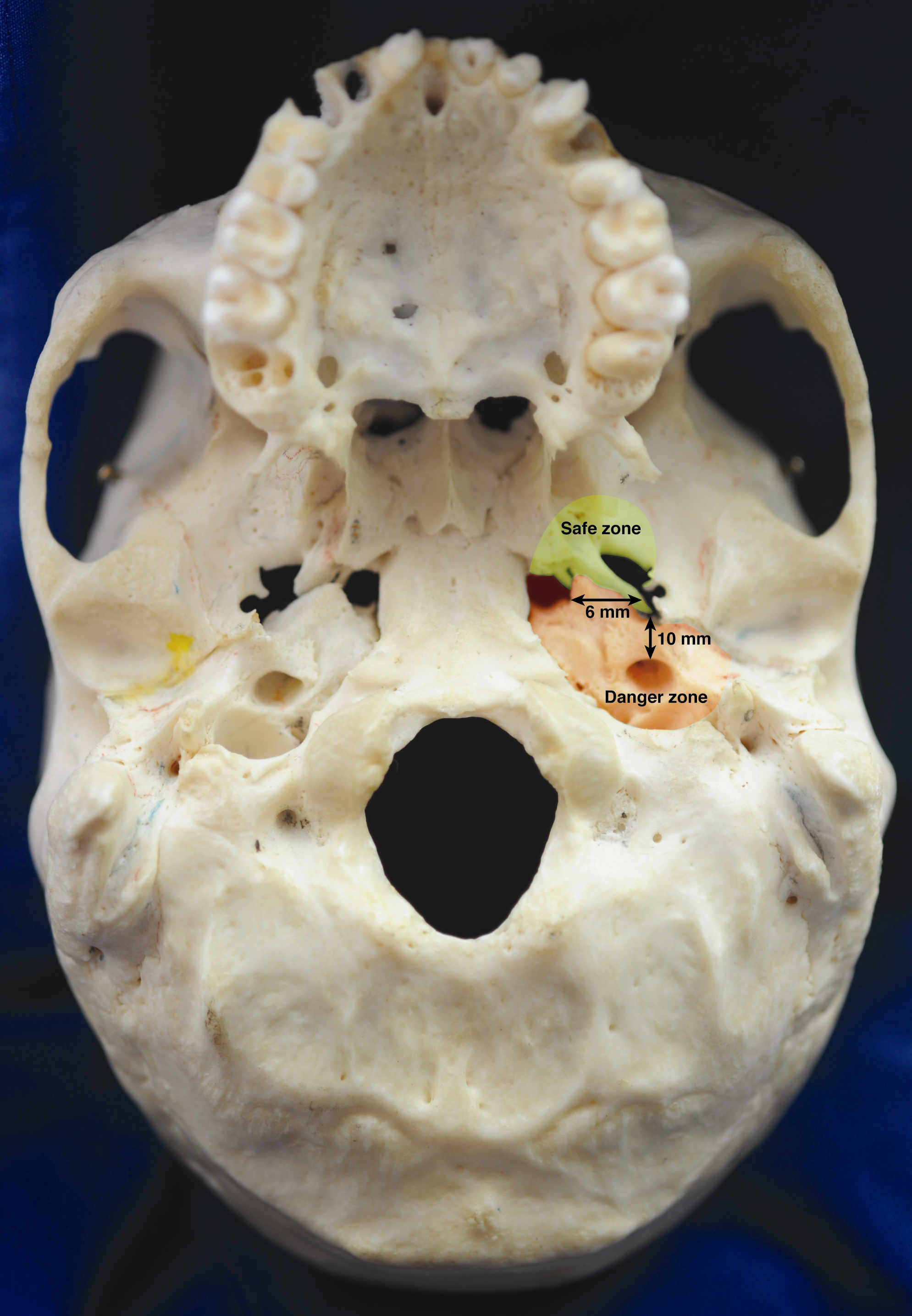 Placement of Needle in the Foramen | The Neurosurgical Atlas