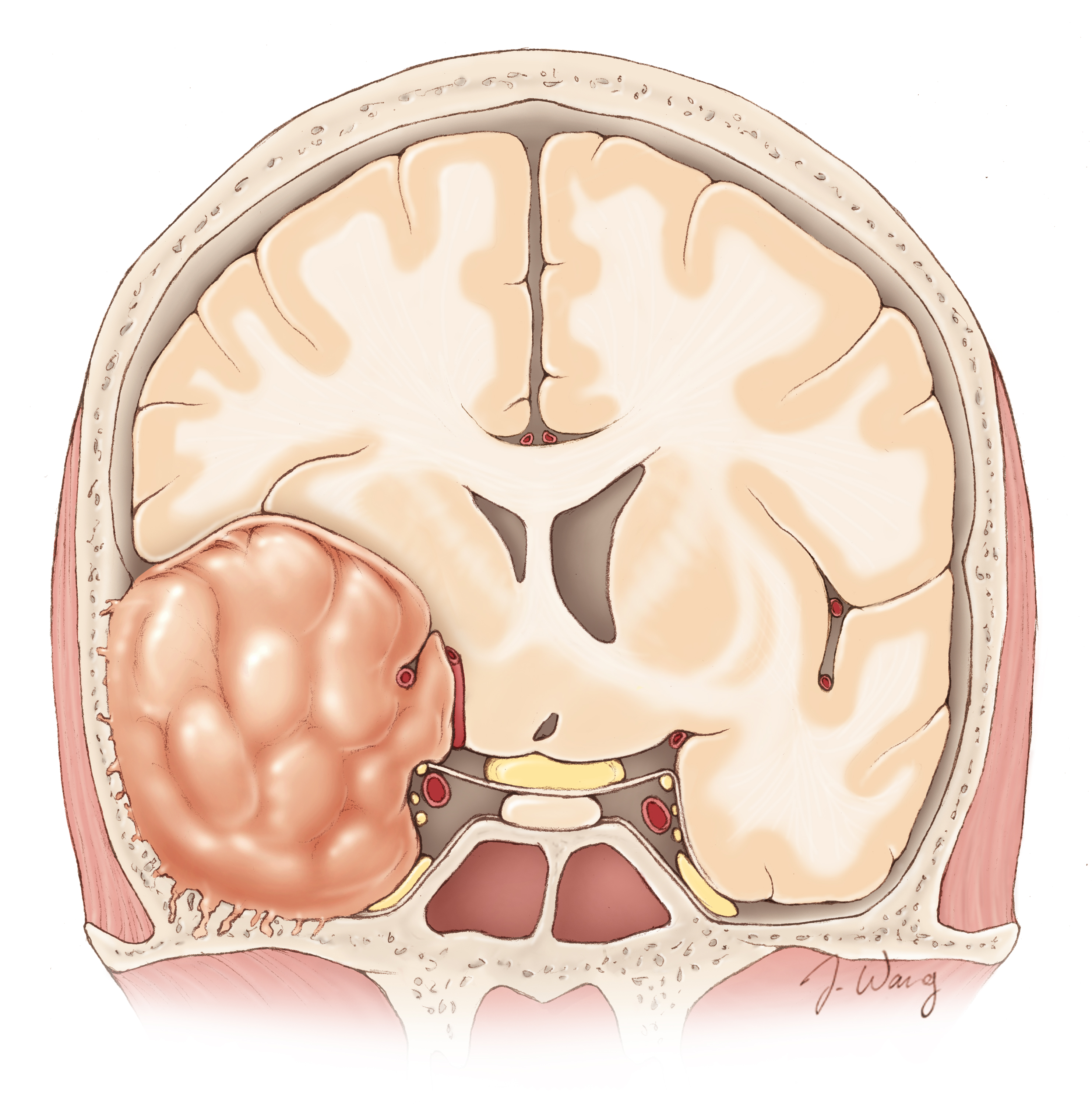 General Information For Meningiomas Patient Resource Center The
